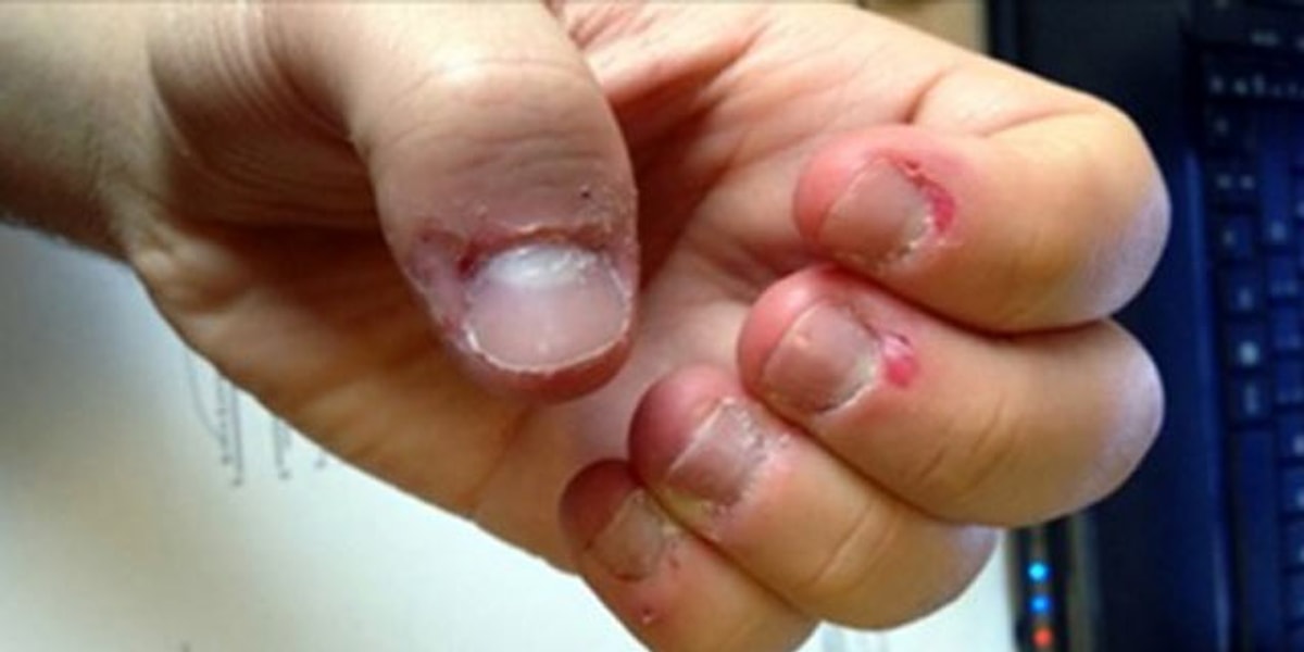 The Scary Disorder That Makes You Eat Yourself: Dermatophagia - Onedio