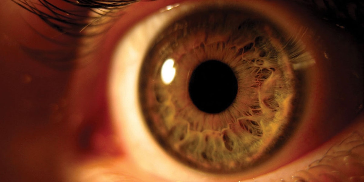 Astigmat Nedir? Astigmat Belirtileri ve Tedavisi - Onedio