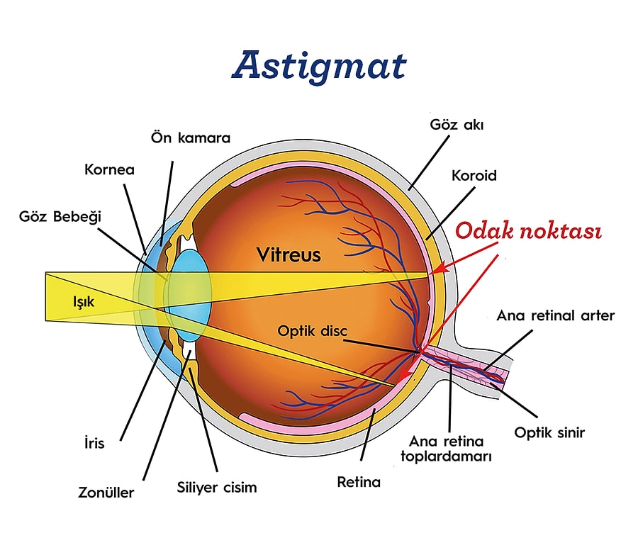 Astigmat Nedir? Astigmat Belirtileri ve Tedavisi - Onedio