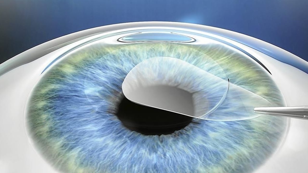 Katarakt Nedir, Neden Olur? Katarakt Belirtileri ve Tedavisi… - Onedio