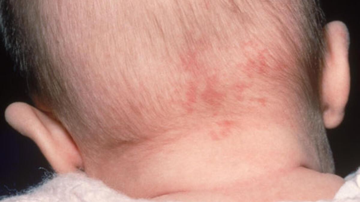 Bebeklerde İsilik Neden Olur, Nasıl Tedavi Edilir? - Onedio