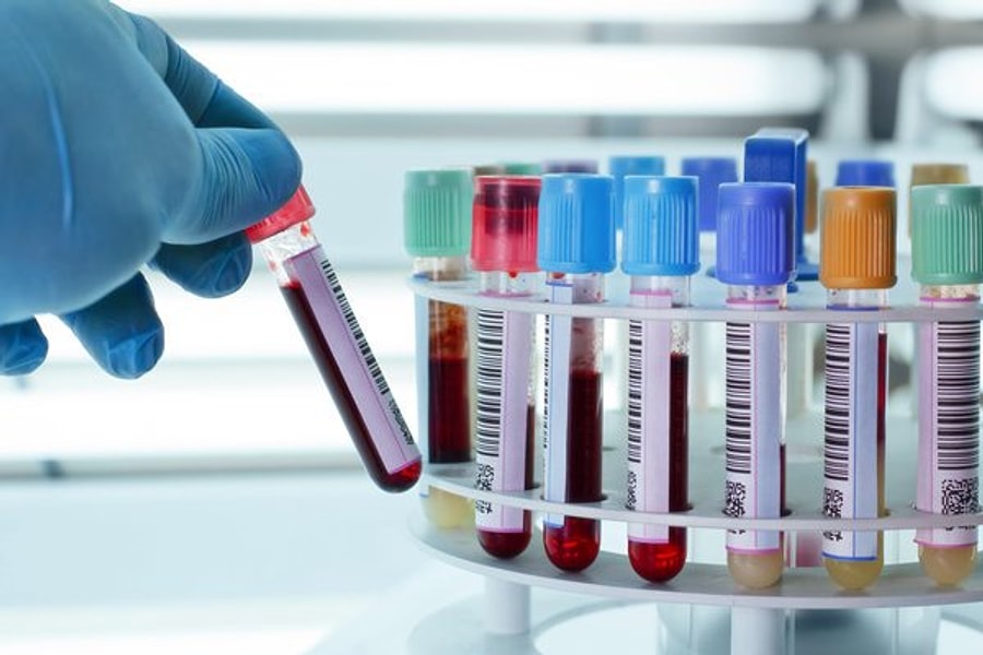 MO%: Monosit Yüzdesi Nedir? Yüksekliği ve Düşüklüğü Ne Anlama Gelir ...