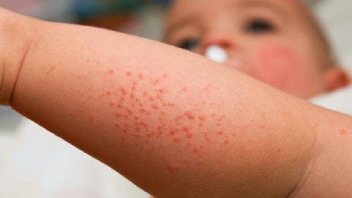 Çocuklarda Atopik Dermatit Belirtileri Tedavisi… - Onedio