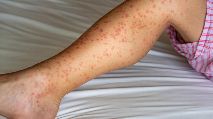 Peteşi Nedir? Belirtileri Nelerdir? - Onedio