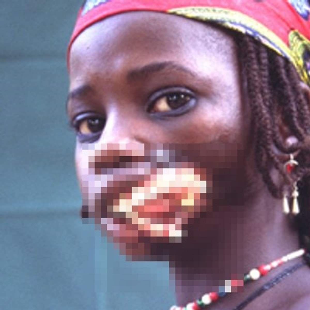 Dünyadaki Birbirinden İlginç 15 Hastalık - Onedio