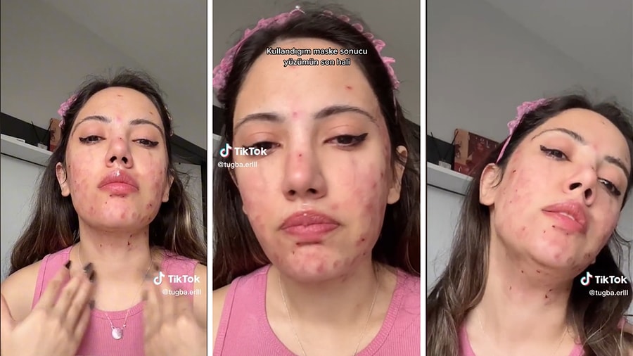 Kullandığı Sivilce Jeli Yüzünden Ağlayarak Acillik Olan Fenomen Tuğba ...