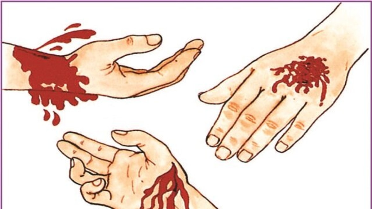 Kısa Sürede Kan Kaybına Neden Olan Kanama Çeşidi - Onedio