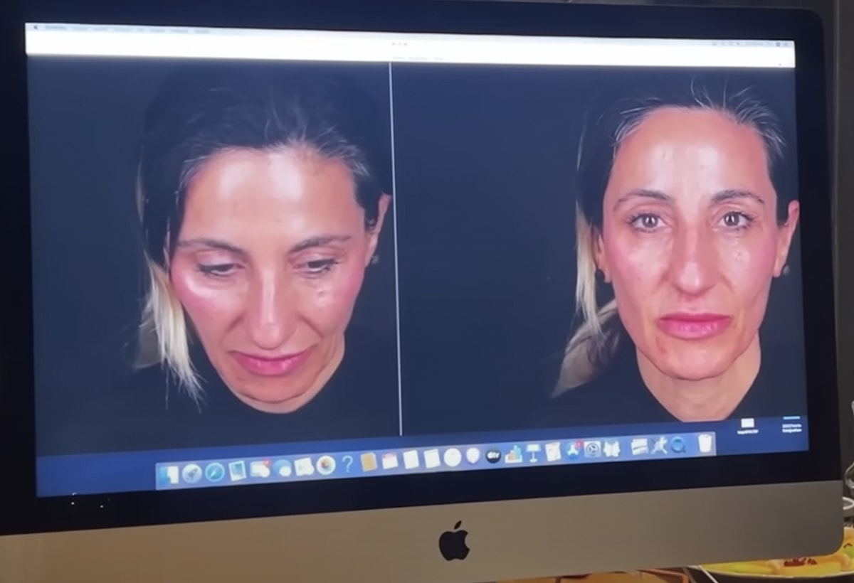 Mika Raun'un Annesi Estetik Yaptırdı! - Onedio