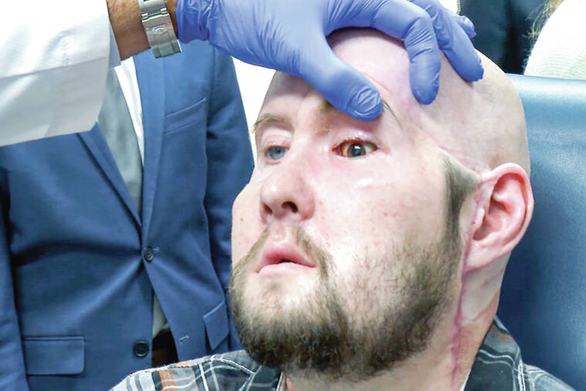 Groundbreaking Eye and Face Transplant Offers New Hope: The Remarkable ...