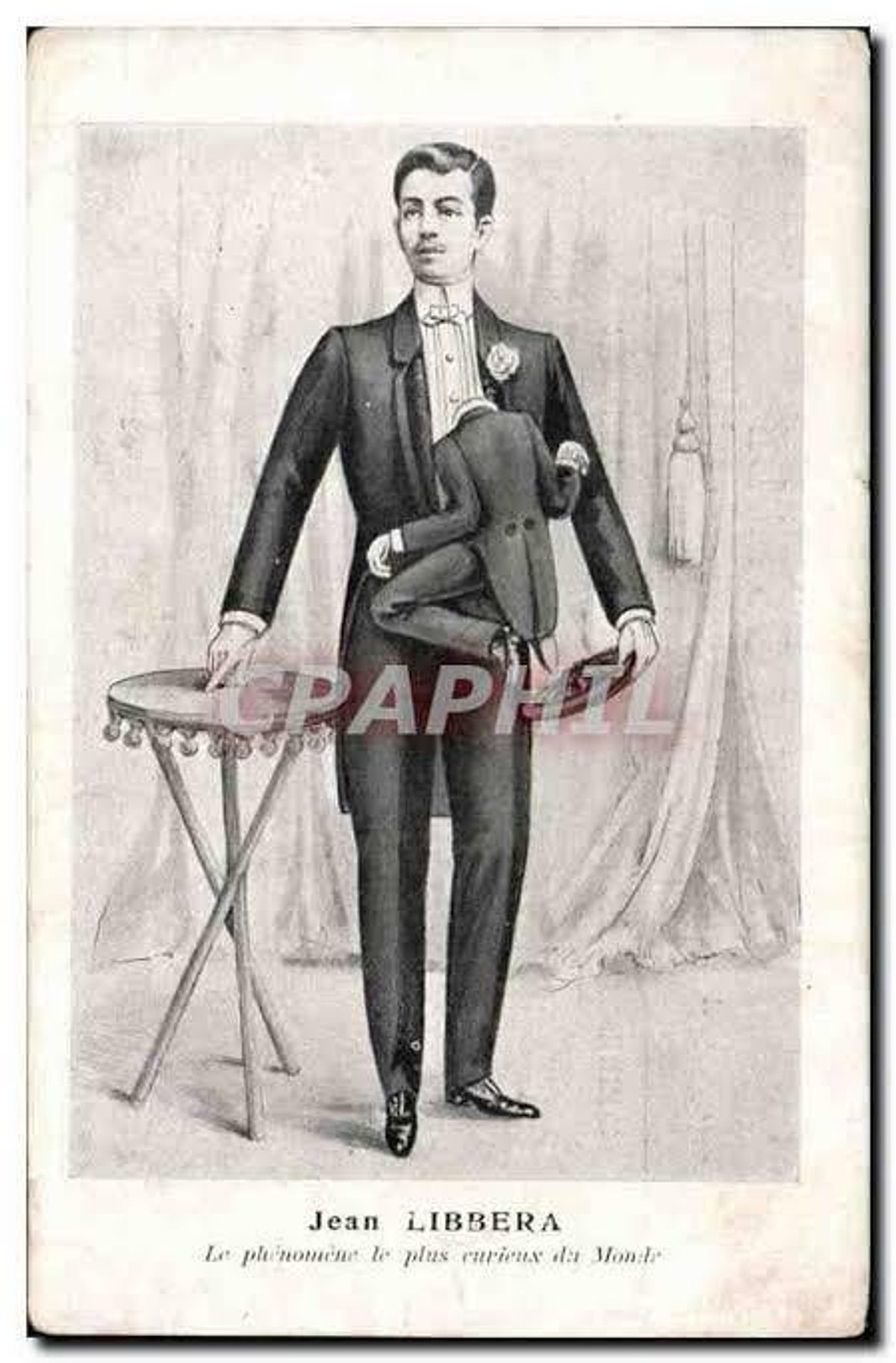 Parazit İkizle Dünyaya Gelen Adamın Hikayesi - Onedio