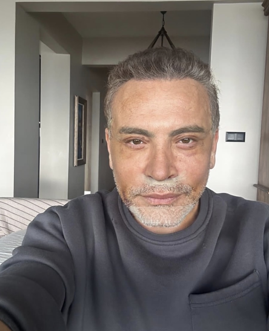 Yüz Gerdirme Ameliyatı Olup Kendine Resmen Aşık Olan Cenk Eren ...