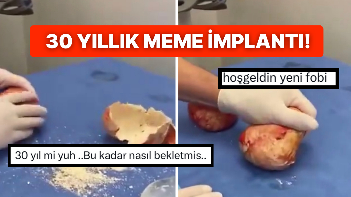 30 Yıllık Bir Meme İmplantındaki Kireçlenmeyi Gösteren Doktor Yeni Fobi ...