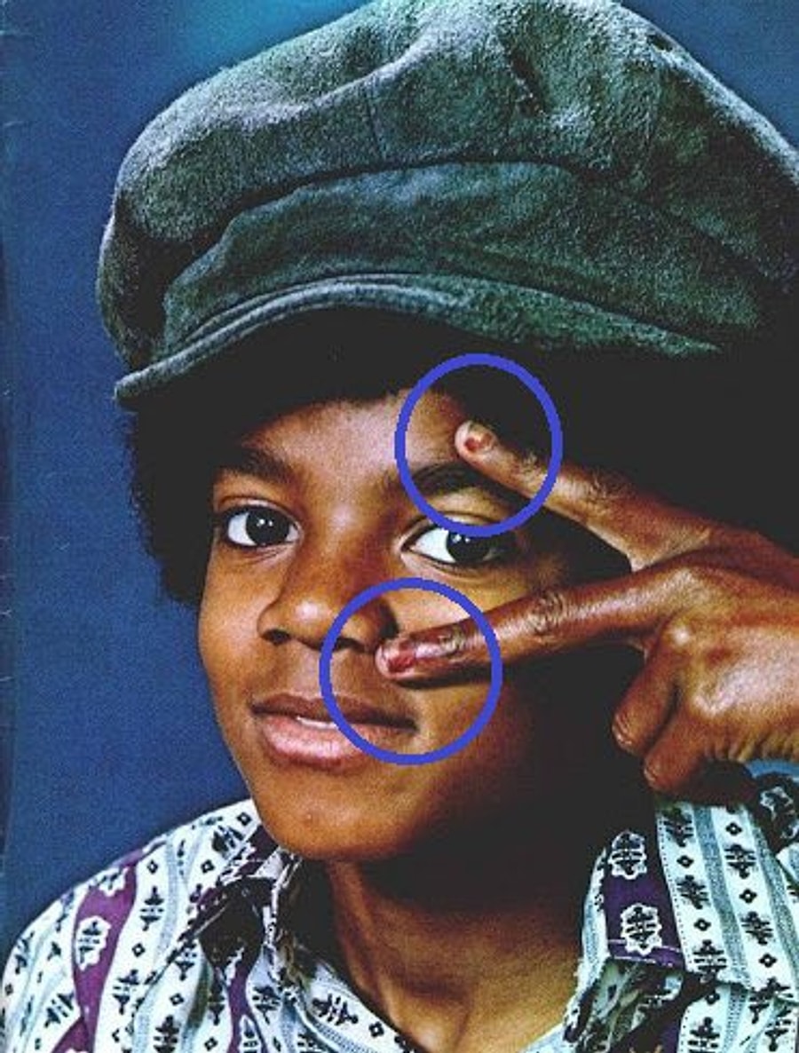 Beyazlamaya Çalıştığı Söylenen Michael Jackson'ın Vitiligo Hastalığına ...