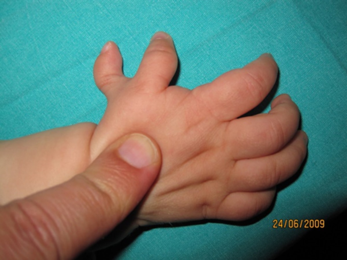 Bazı İnsanlar Neden 6 Parmakla Doğar? - Onedio