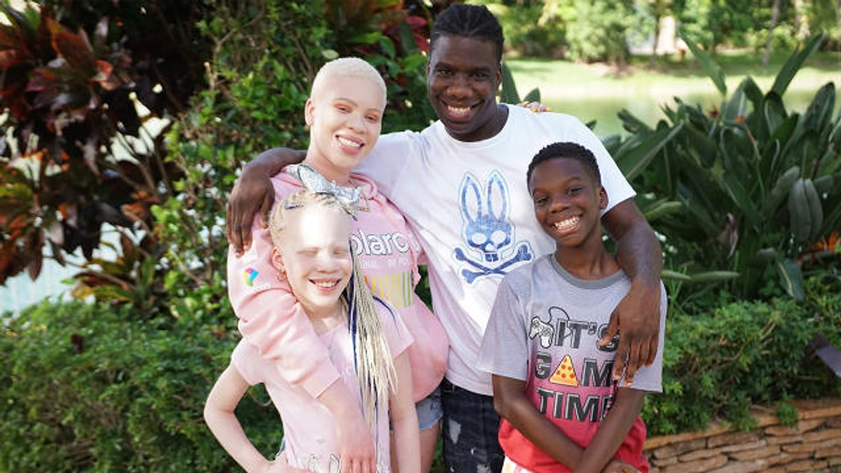Parents Shunned for Having an Albino Child: A Heartbreaking Story of ...