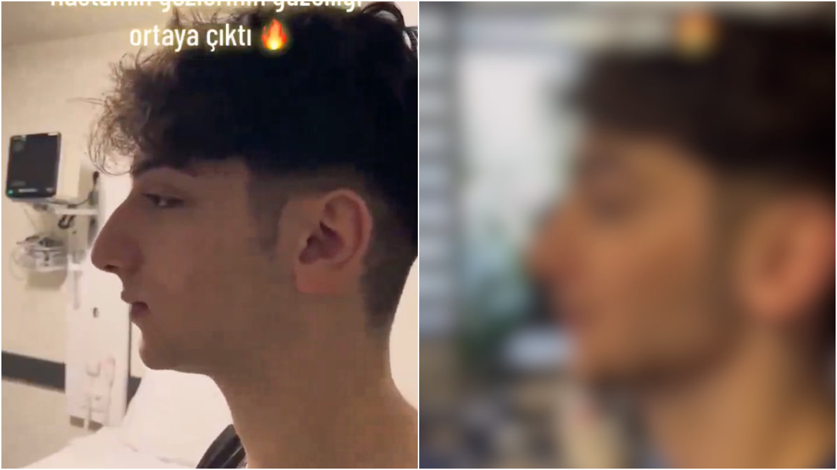 The Change He Experienced with Rhinoplasty - Onedio