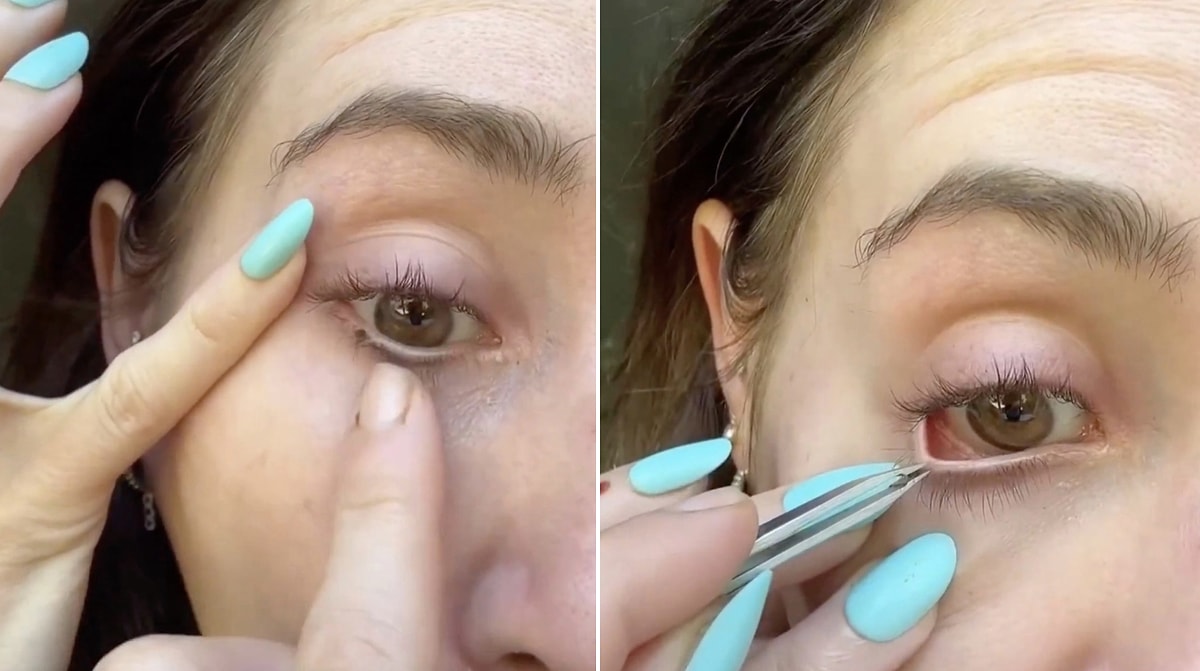 Woman Removes Tick From Her Eye Using Tweezers - Onedio